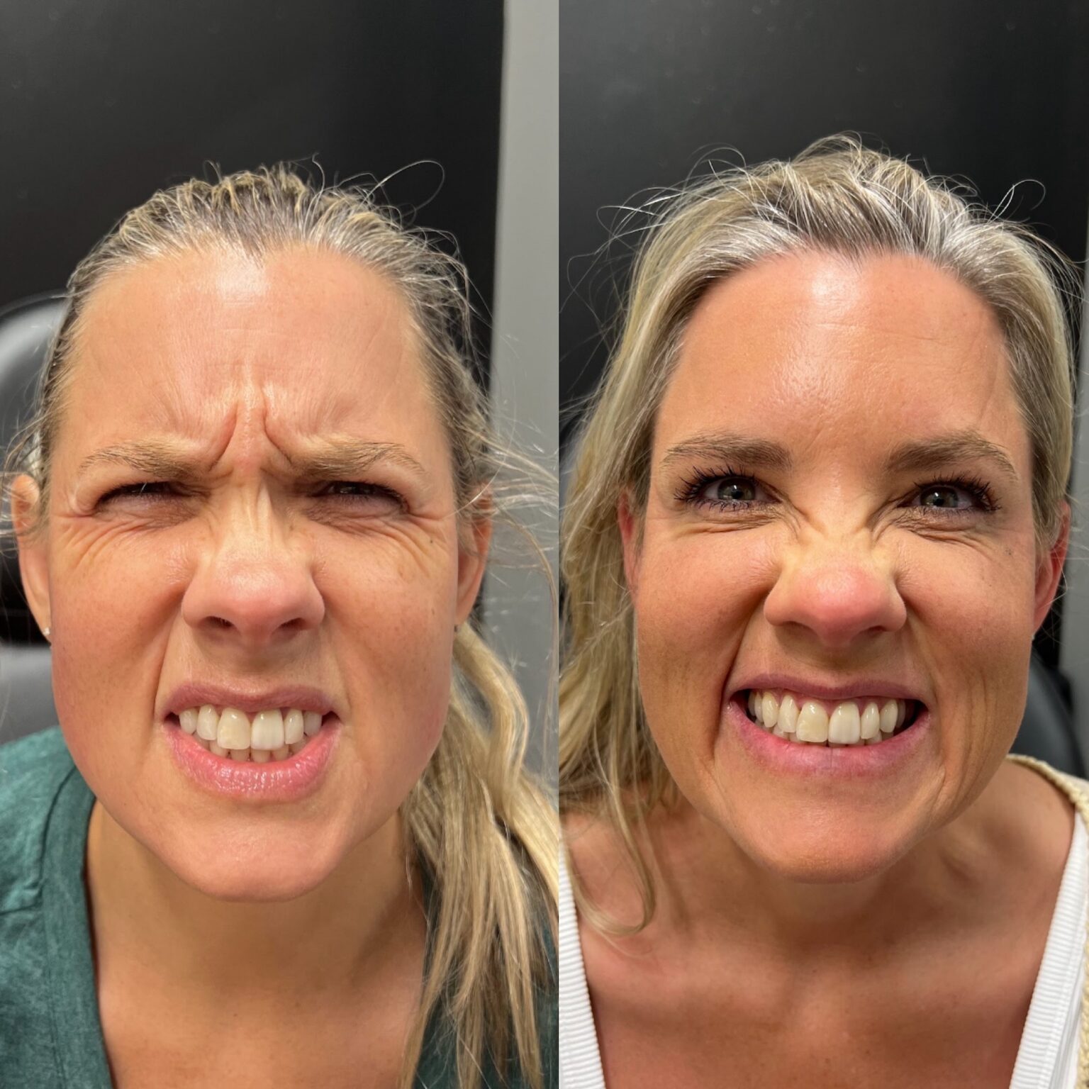 Botox 1 | Purity Skin Studio