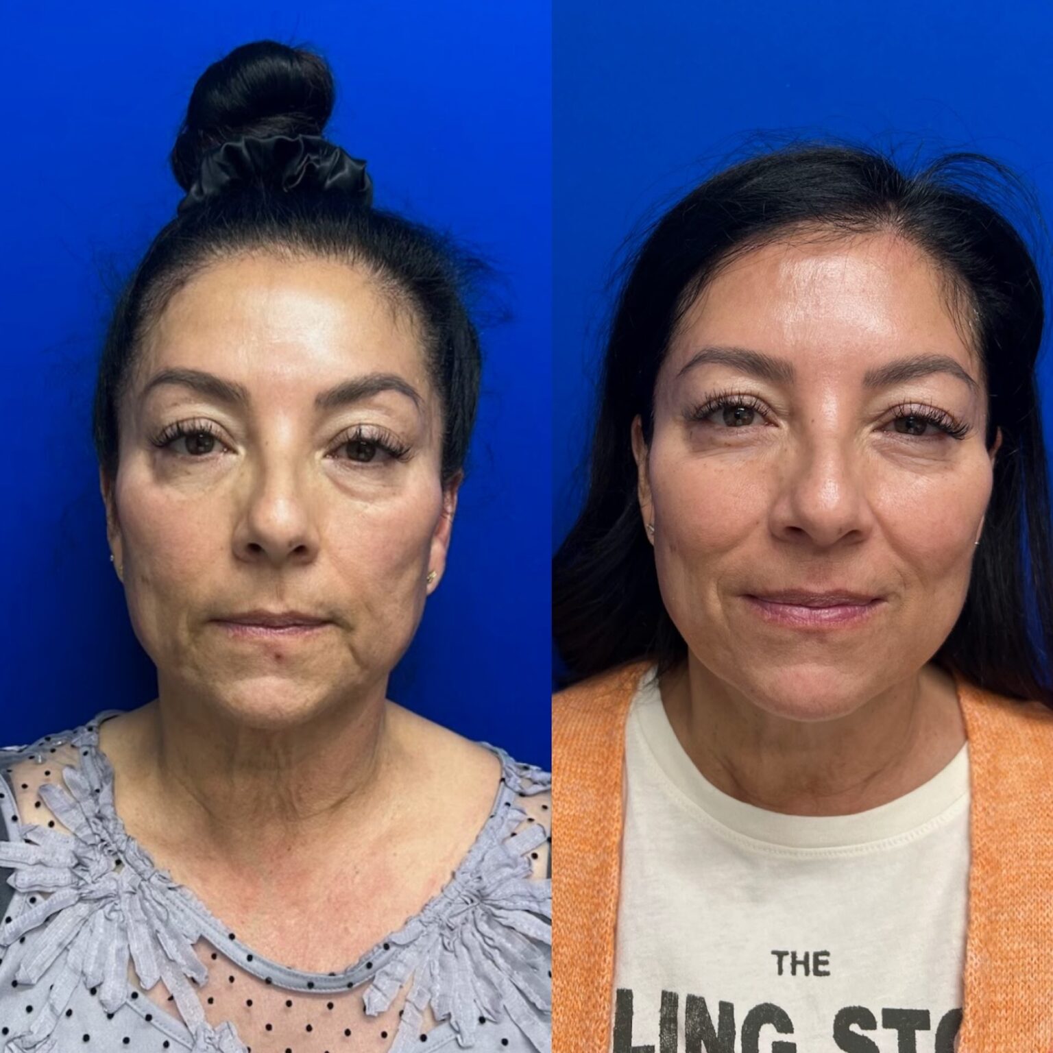 SylfirmX 1 | Purity Skin Studio