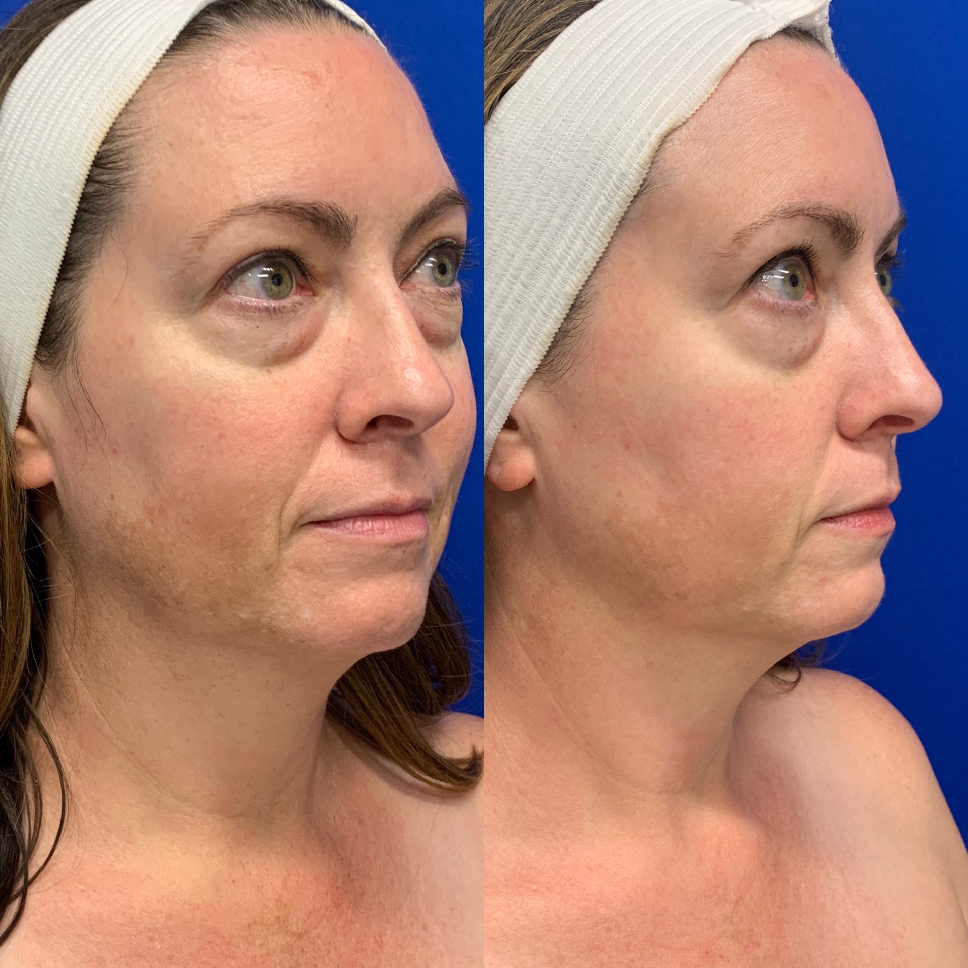 Before & After Archive | Purity Skin Studio