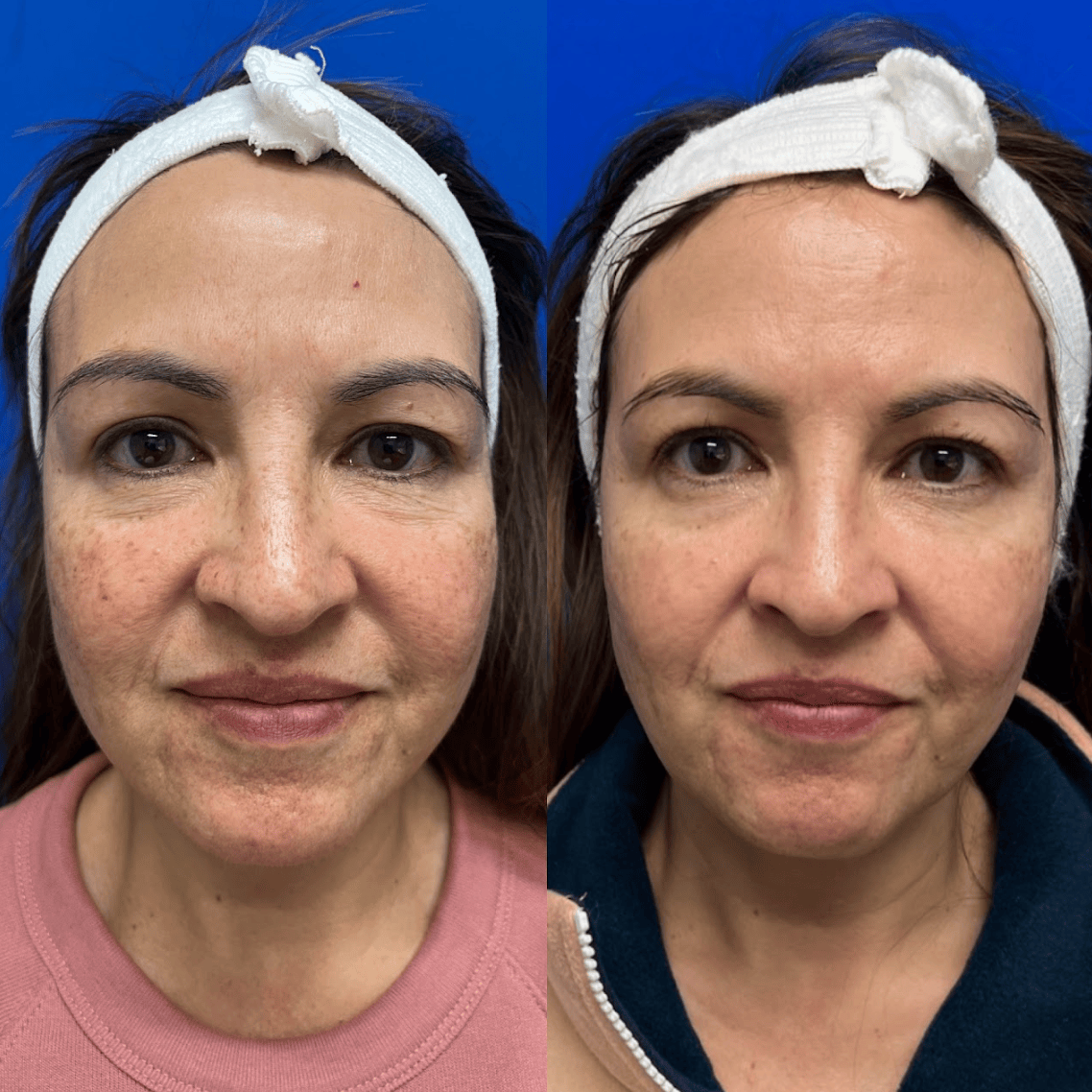 Microneedling 2 | Purity Skin Studio