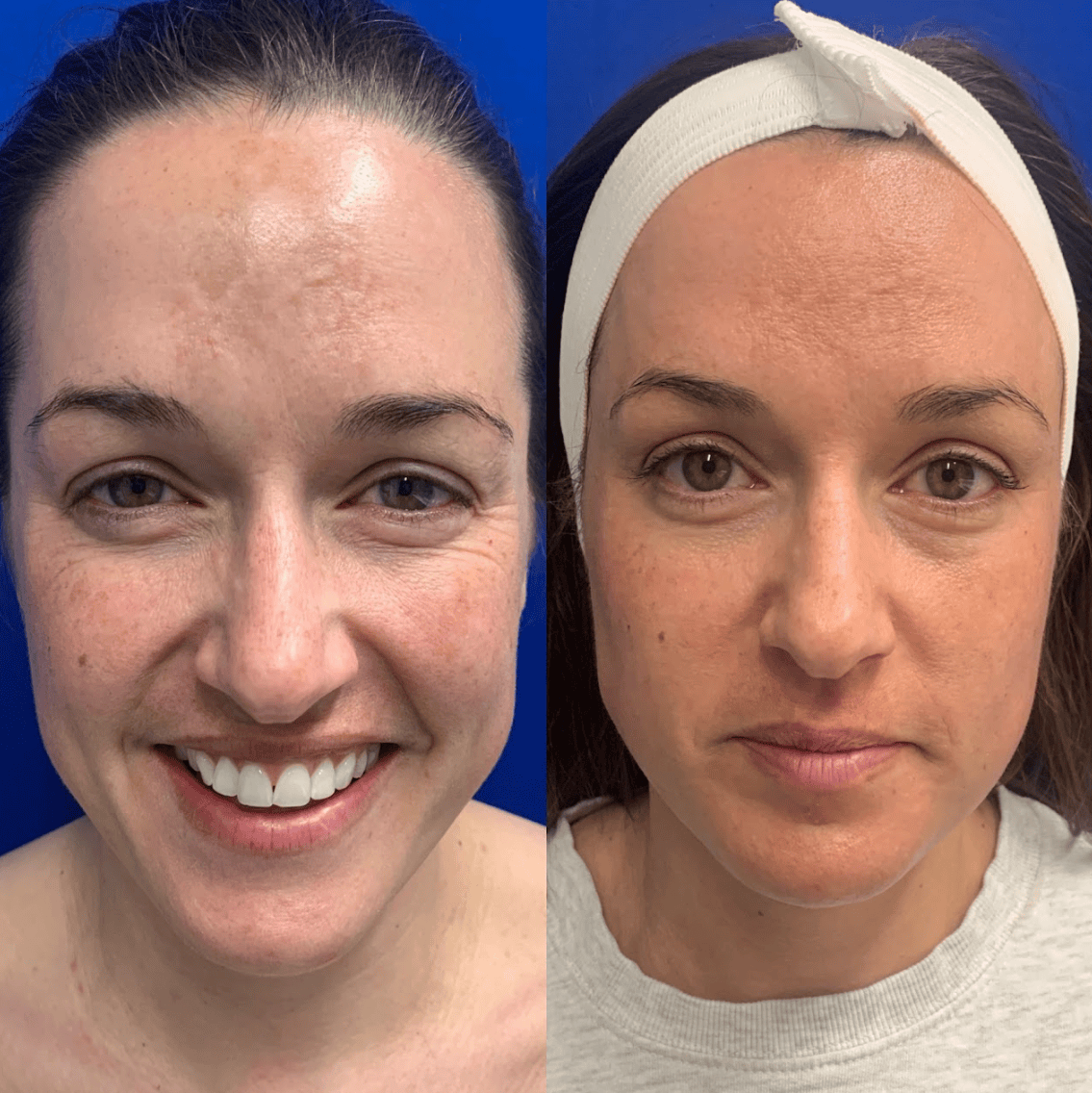 Moxi Skin Resurfacing 2 | Purity Skin Studio